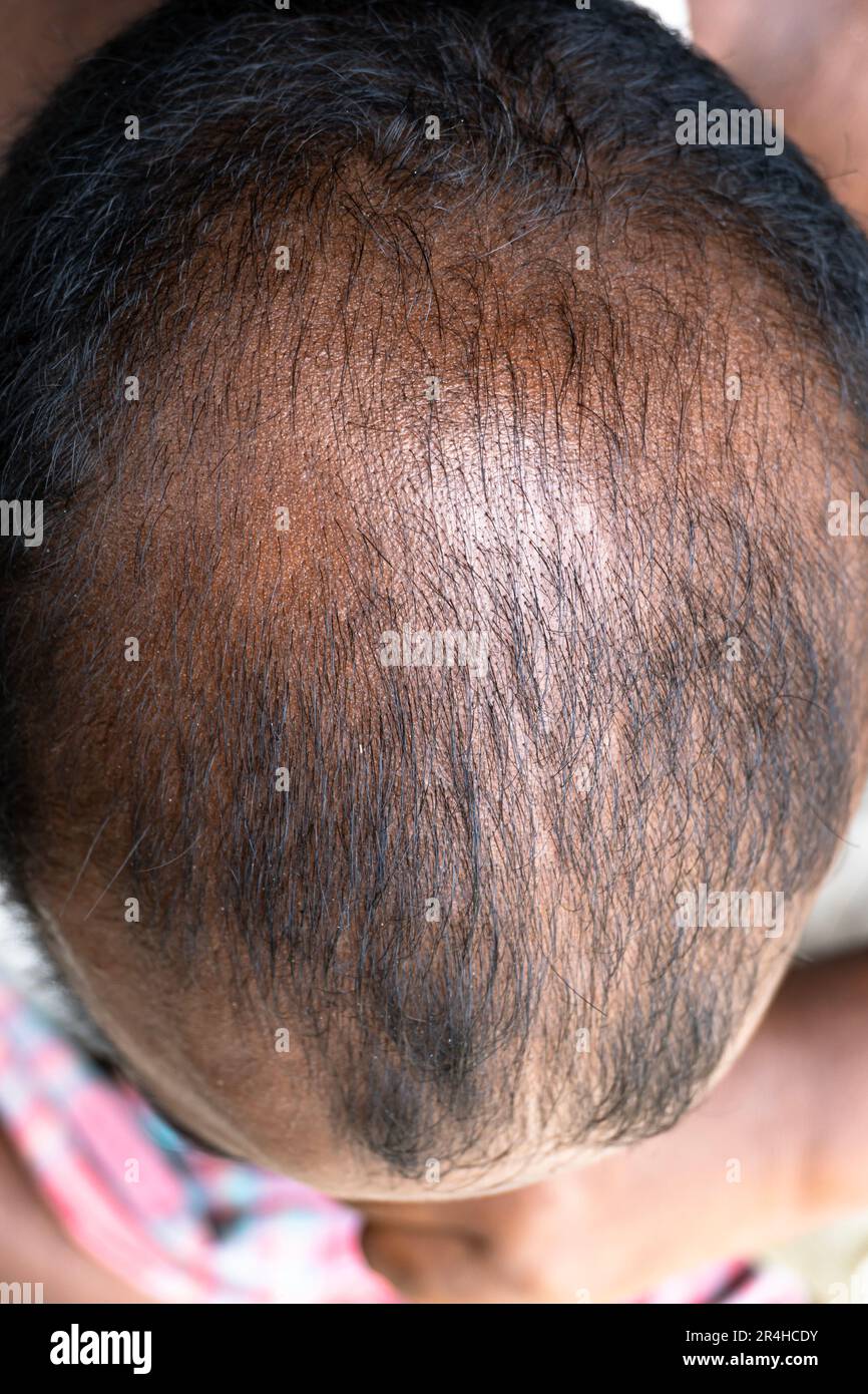 Bald head of a black asian man. Hair loss in men Stock Photo - Alamy