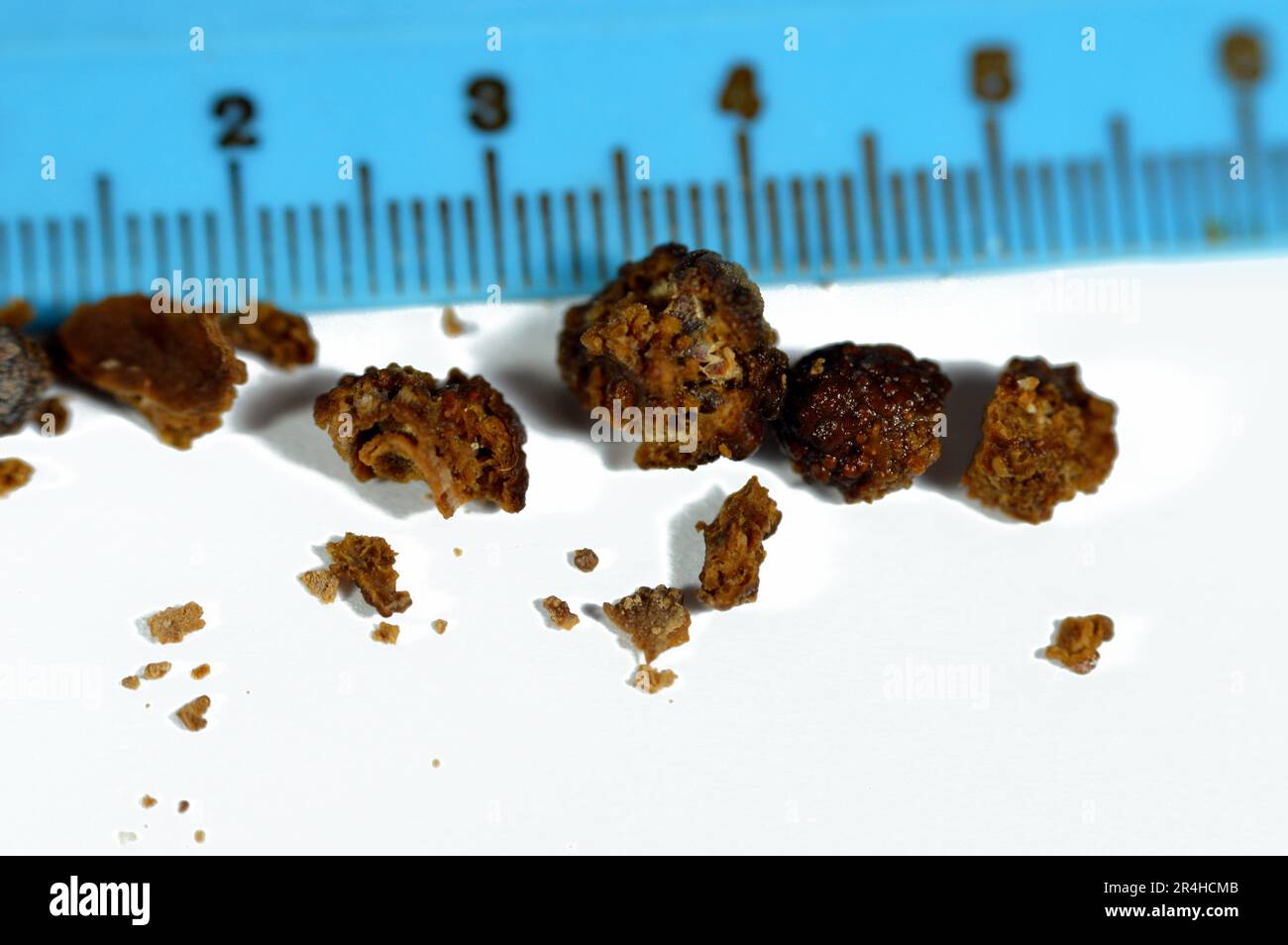 Nephrolithiasis, irregular brown kidney stones (renal calculus or ...