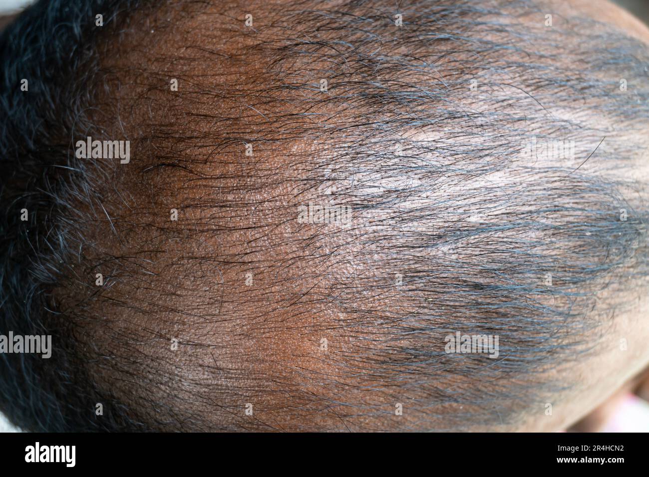 Bald head of an adult man from the back. Alopecia on the head. Bald ...