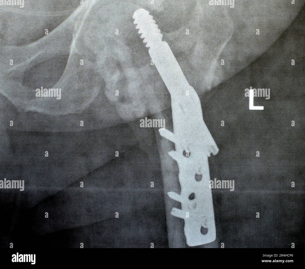 Left hip trans cervical neck of femur fracture fixated by DHS Dynamic ...