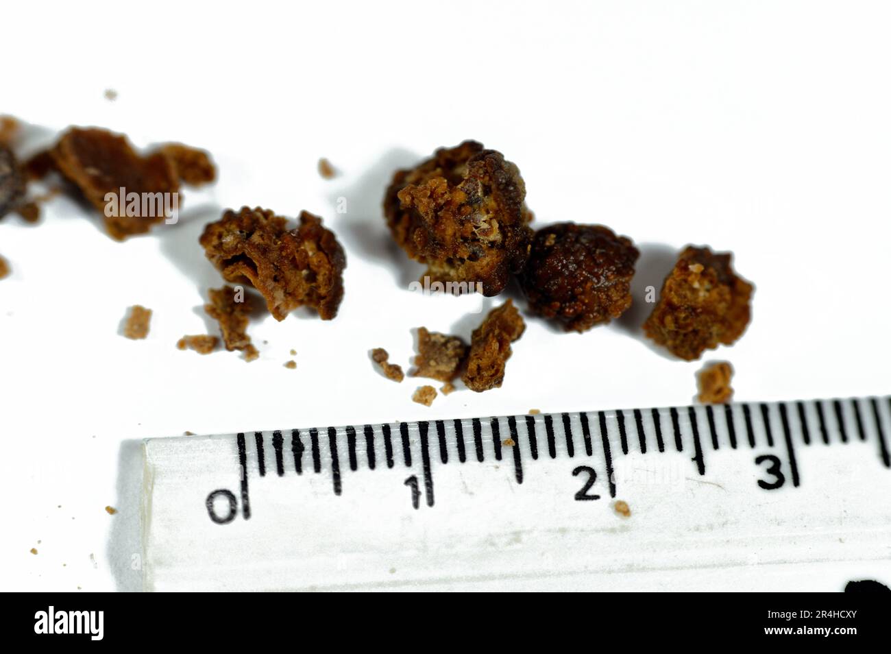 Nephrolithiasis, irregular brown kidney stones (renal calculus or ...