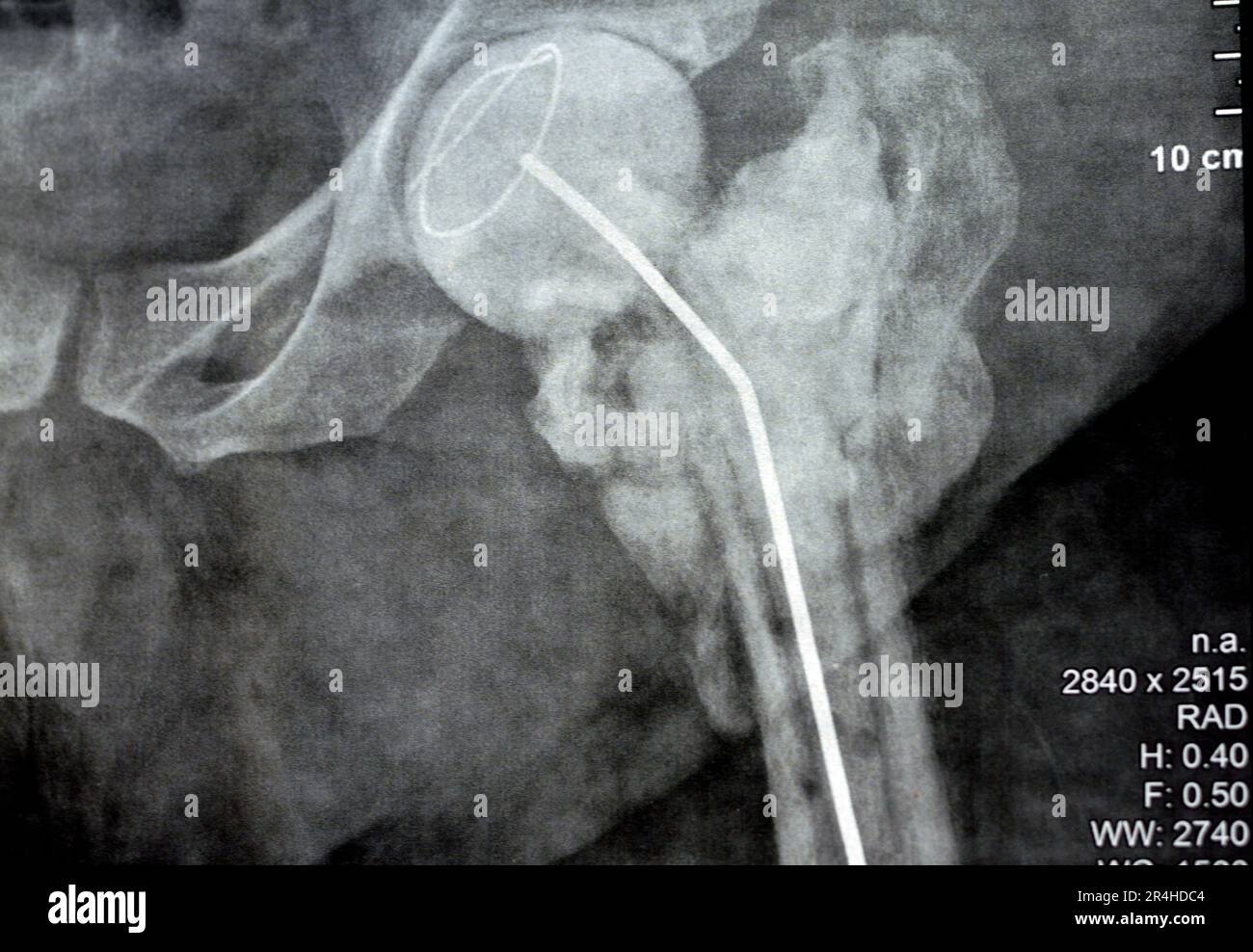 Plain X ray hip joint show left trans cervical fracture of the head of ...