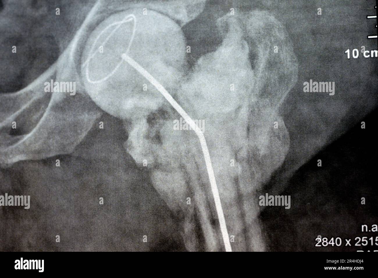 Plain X ray hip joint show left trans cervical fracture of the head of ...