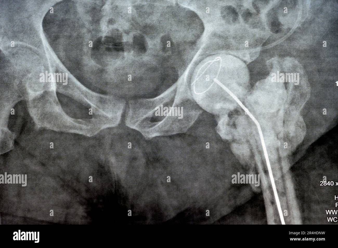 Plain X ray hip joint show left trans cervical fracture of the head of ...