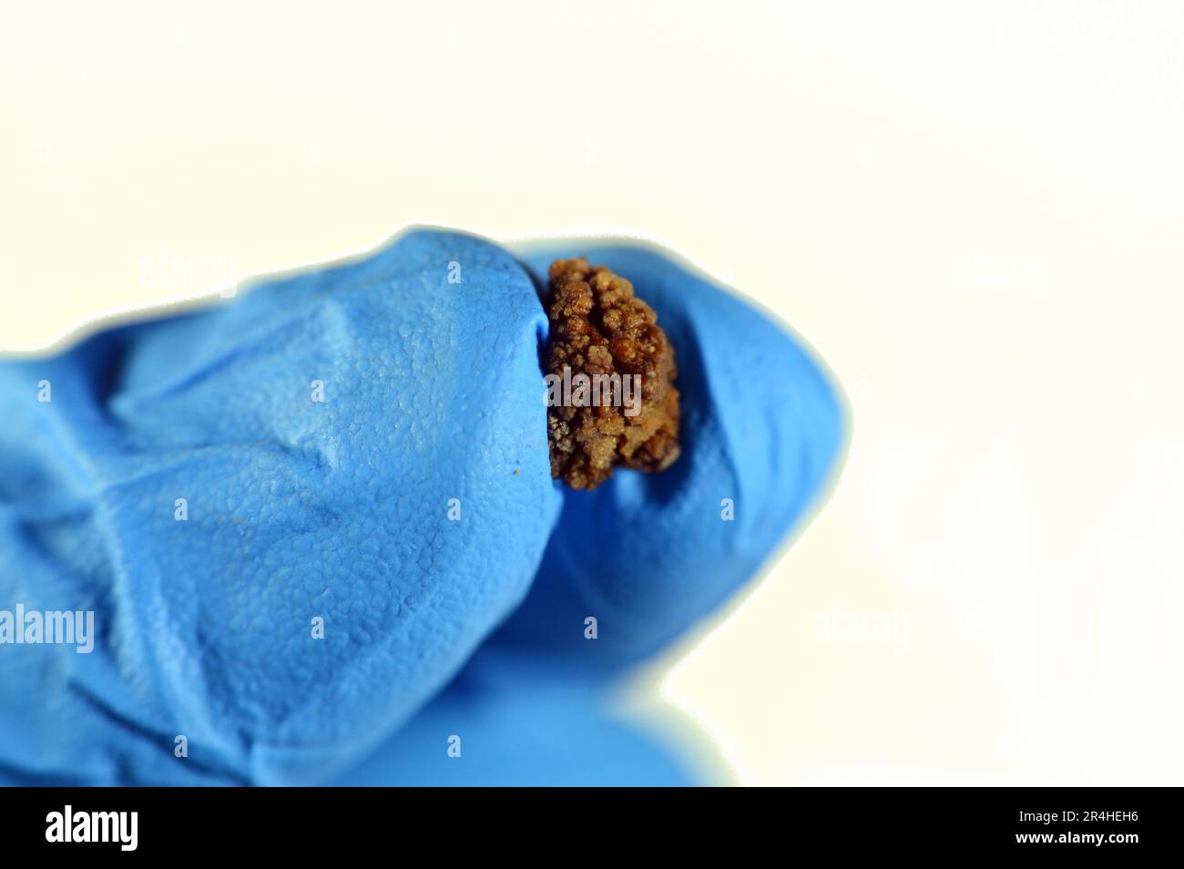 Nephrolithiasis, irregular brown kidney stones (renal calculus or ...