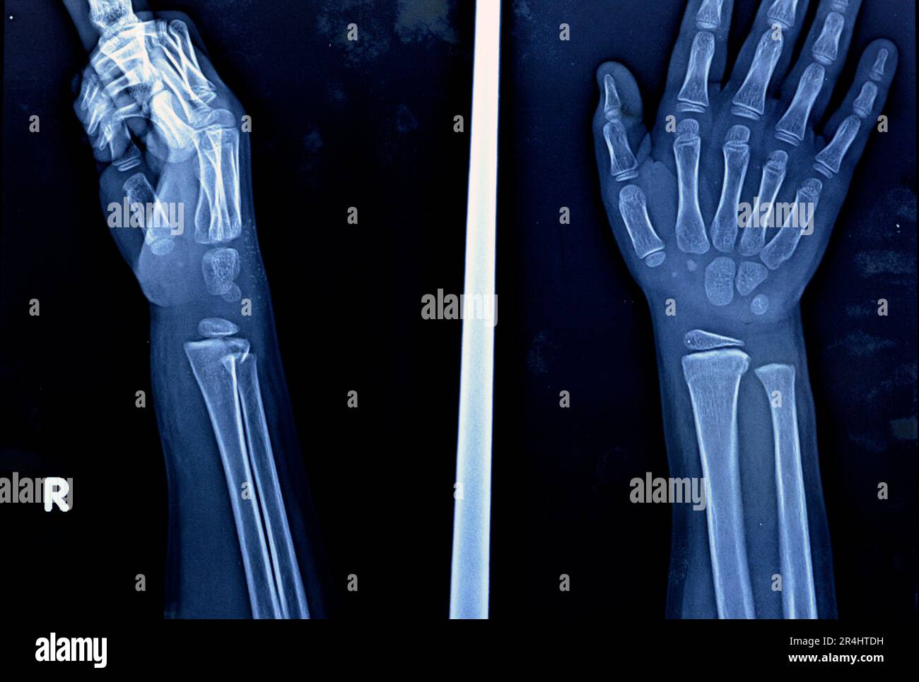 A PXR plain x ray of right wrist joint of skeletally immature female ...
