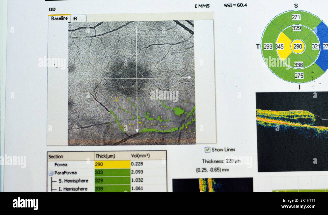 OCT of the eye reveals faint epimacular membrane and full thickness ...