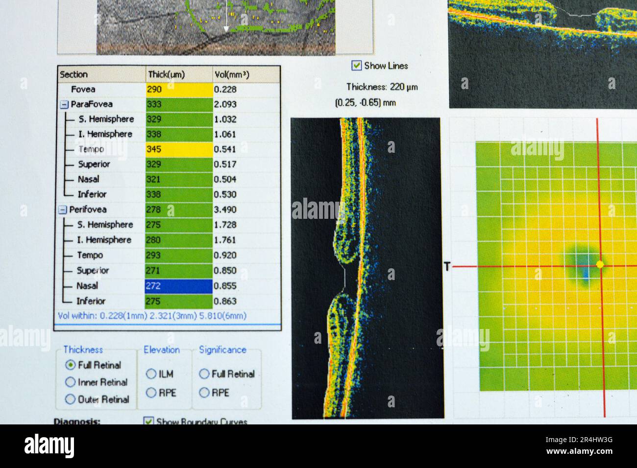 OCT of the eye reveals faint epimacular membrane and full thickness ...