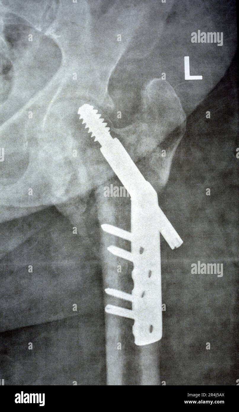 Left hip trans cervical neck of femur fracture fixated by DHS Dynamic ...