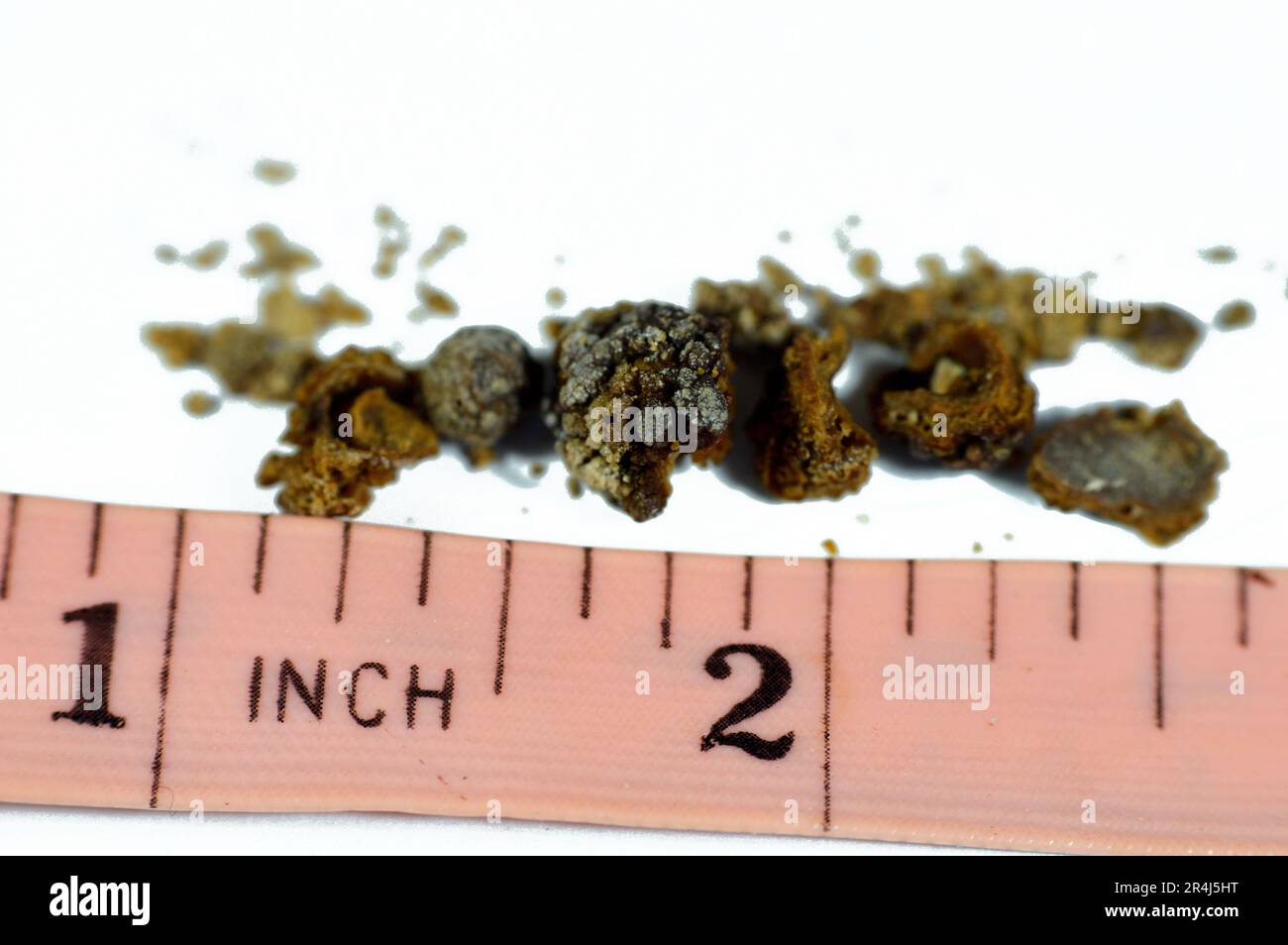 Nephrolithiasis, irregular brown kidney stones (renal calculus or ...