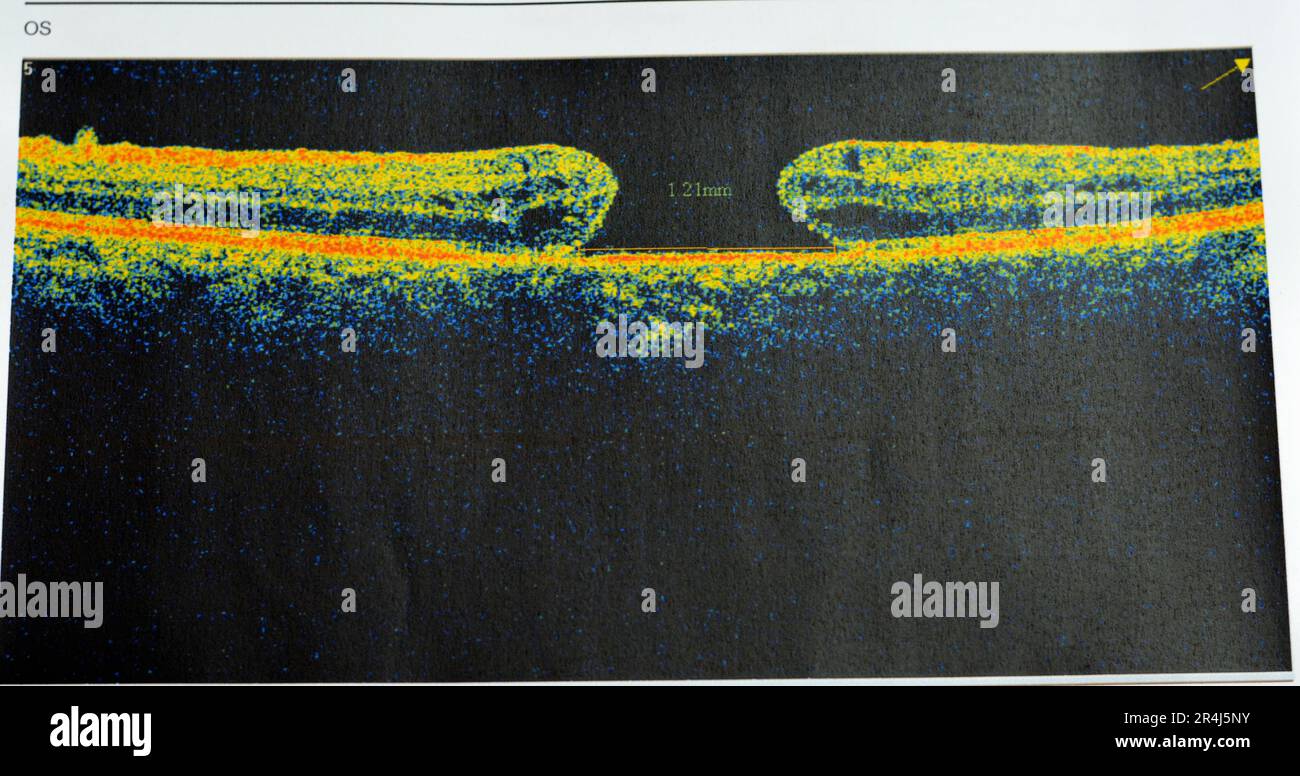 OCT of the eye reveals faint epimacular membrane and full thickness ...