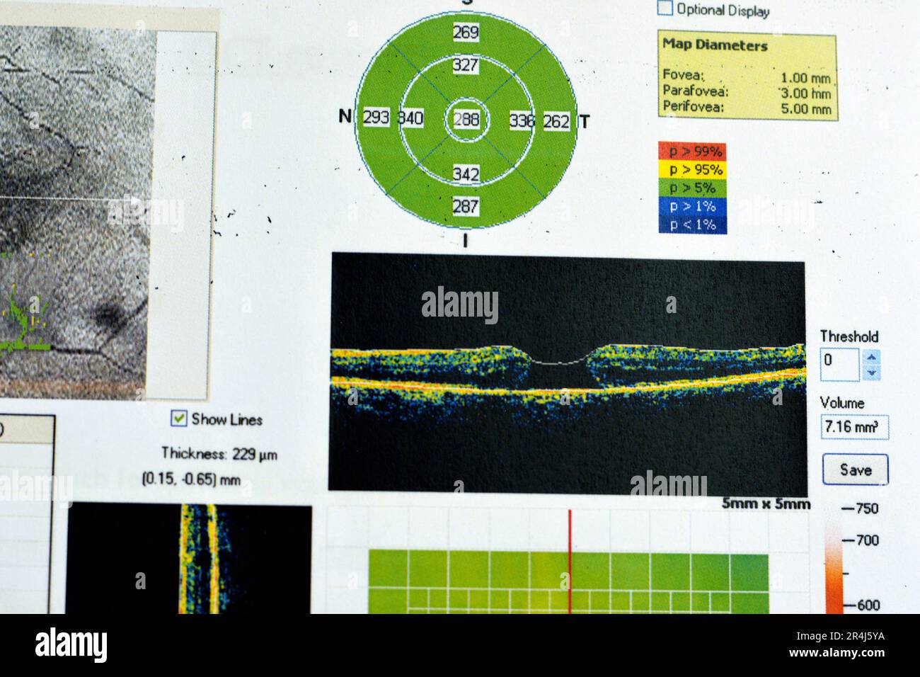 OCT of the eye reveals faint epimacular membrane and full thickness ...