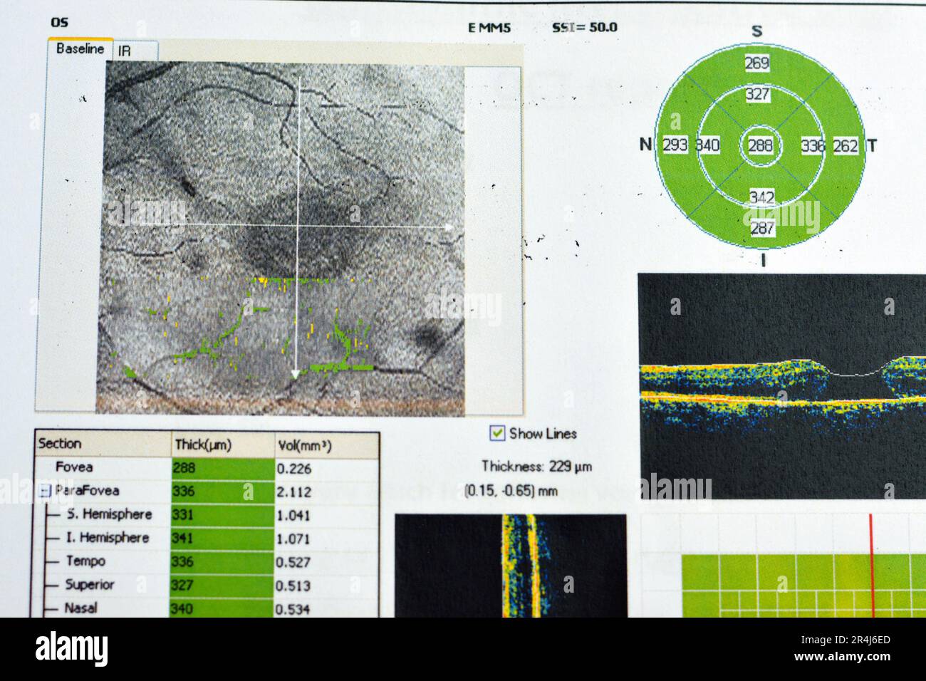 OCT of the eye reveals faint epimacular membrane and full thickness ...