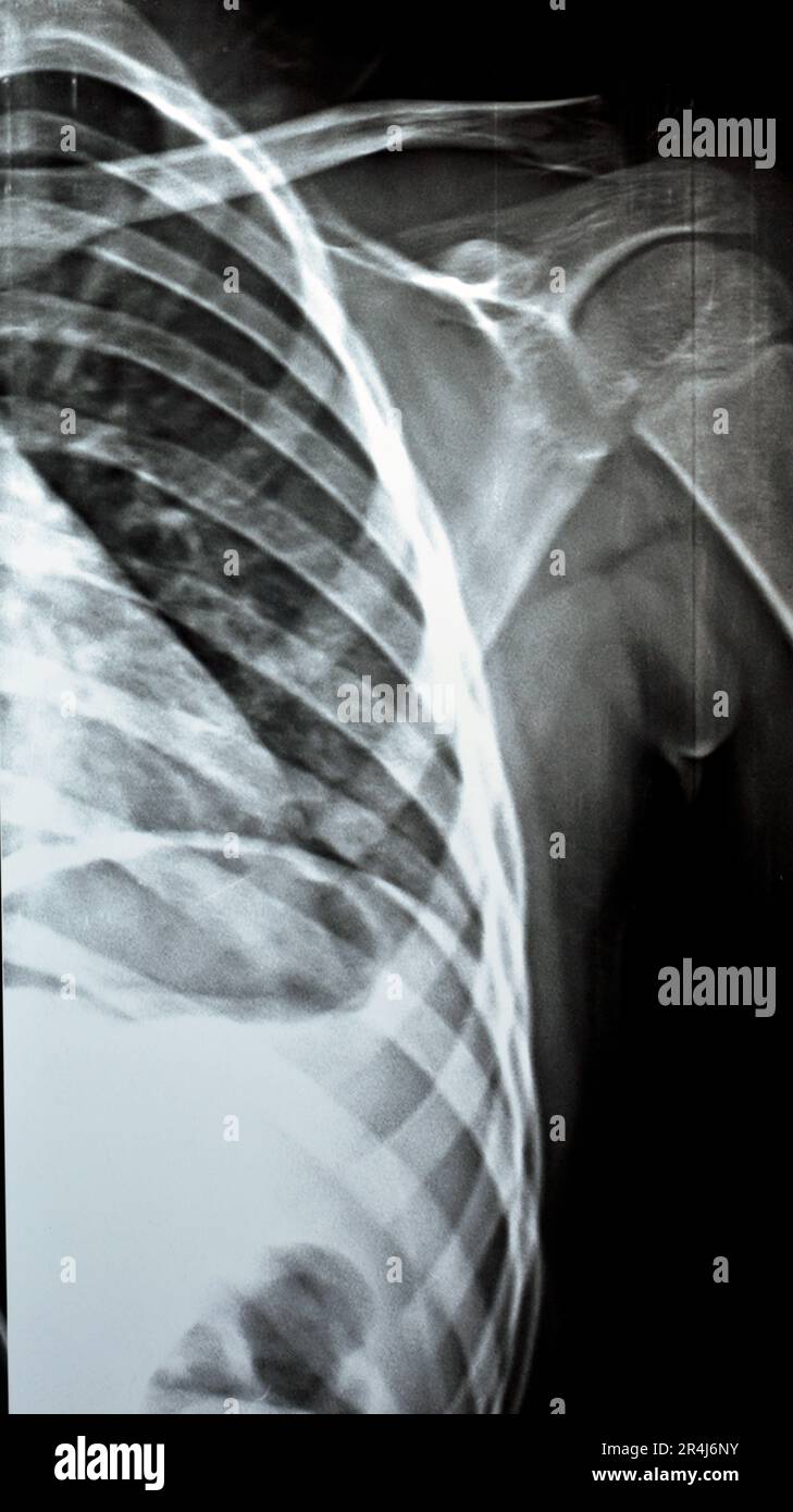 Plain x Ray PXR of left shoulder of skeletally immature female patient ...