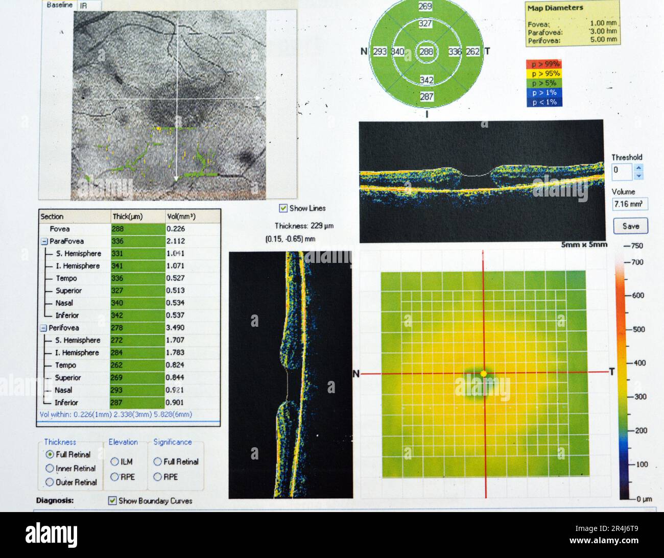 OCT of the eye reveals faint epimacular membrane and full thickness ...