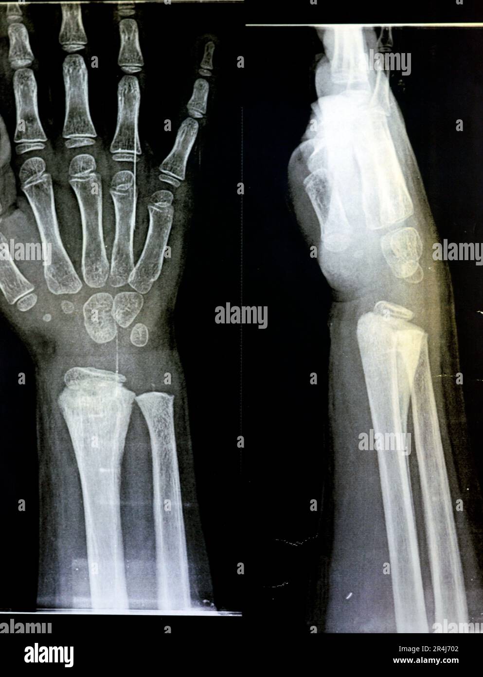 Wrist Joint X Ray