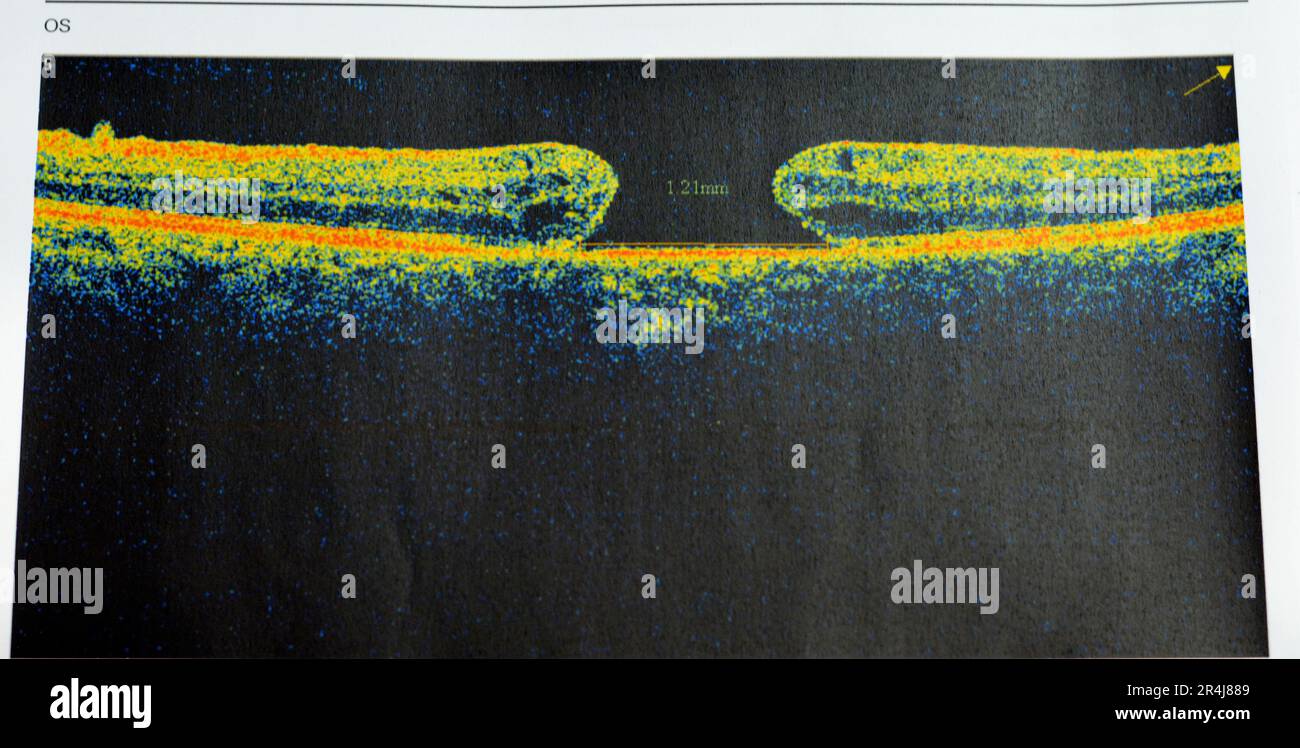 OCT of the eye reveals faint epimacular membrane and full thickness ...
