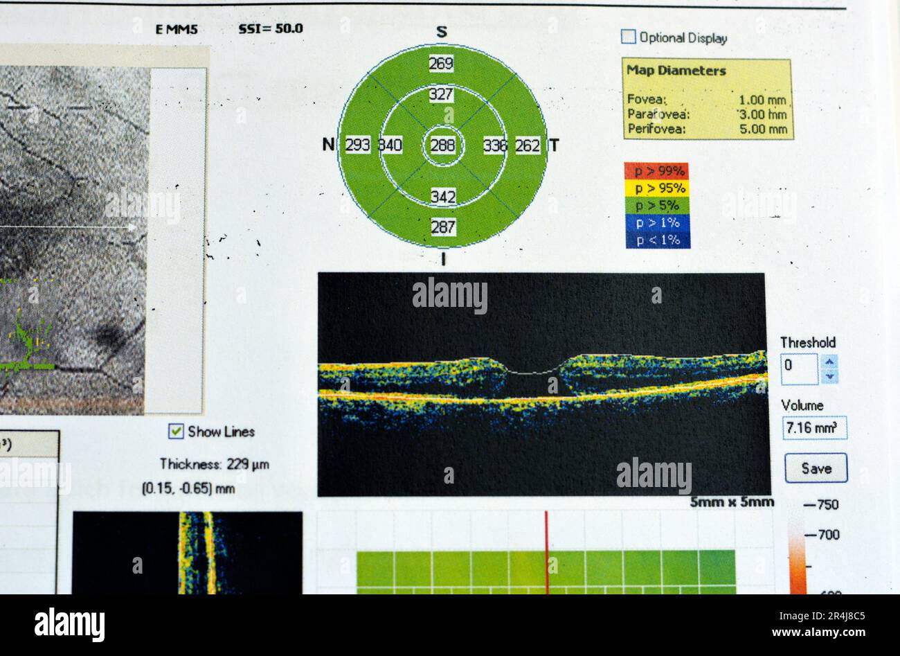 OCT of the eye reveals faint epimacular membrane and full thickness ...