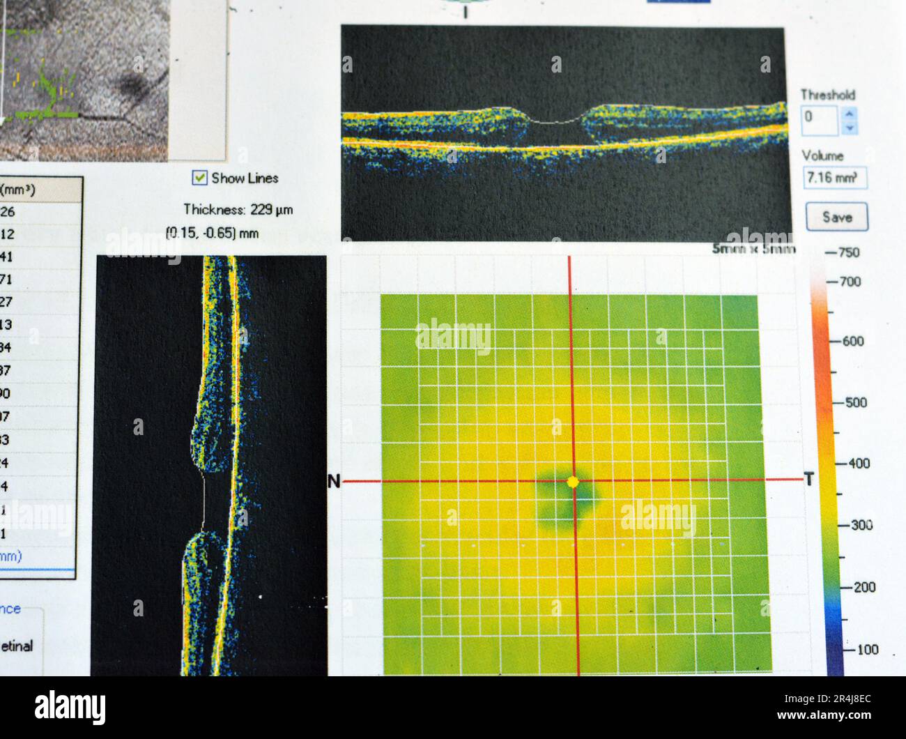 OCT of the eye reveals faint epimacular membrane and full thickness ...