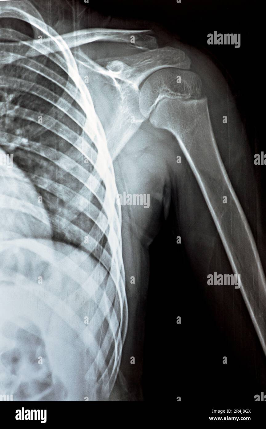 Plain x Ray PXR of left shoulder of skeletally immature female patient ...