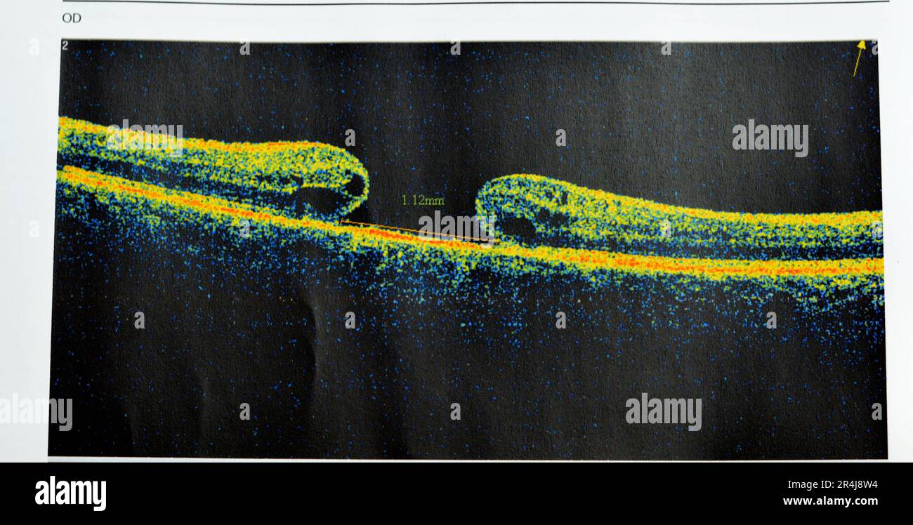 OCT of the eye reveals faint epimacular membrane and full thickness ...