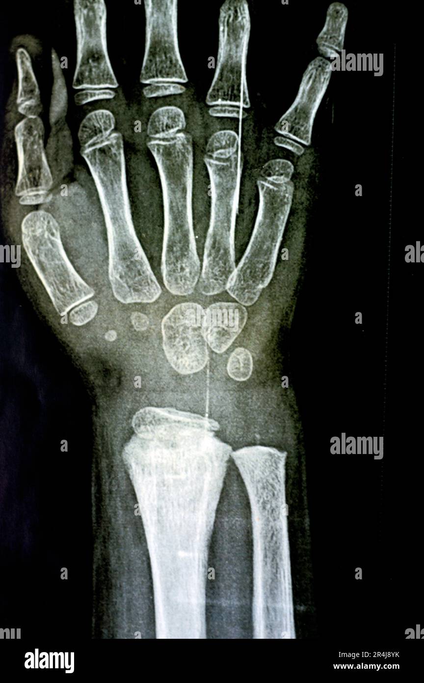 A PXR plain x ray of right wrist joint of skeletally immature female ...