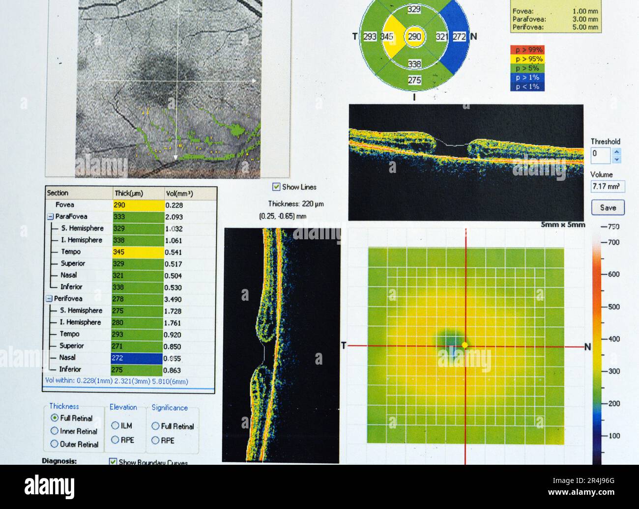 OCT of the eye reveals faint epimacular membrane and full thickness ...