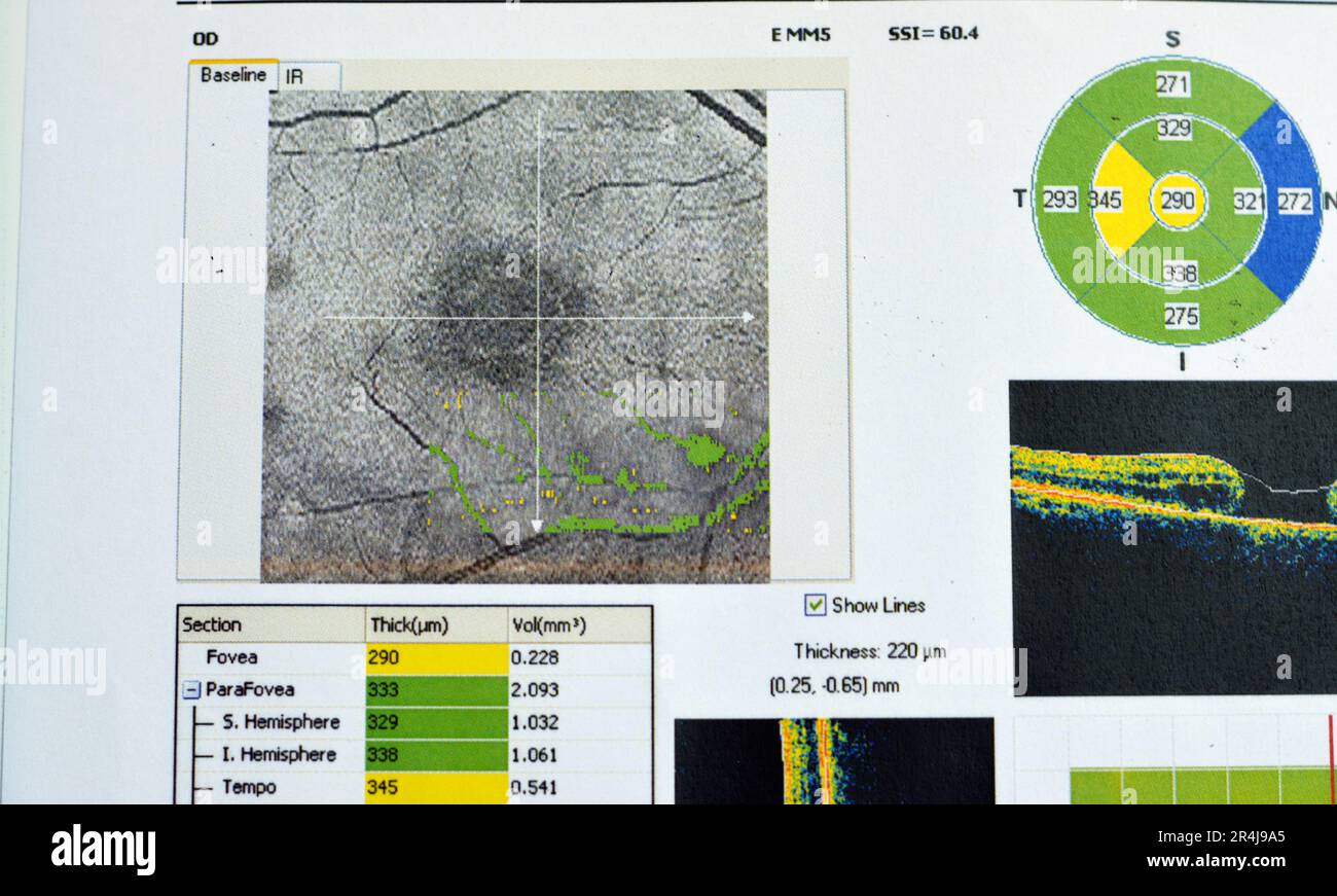 OCT of the eye reveals faint epimacular membrane and full thickness ...