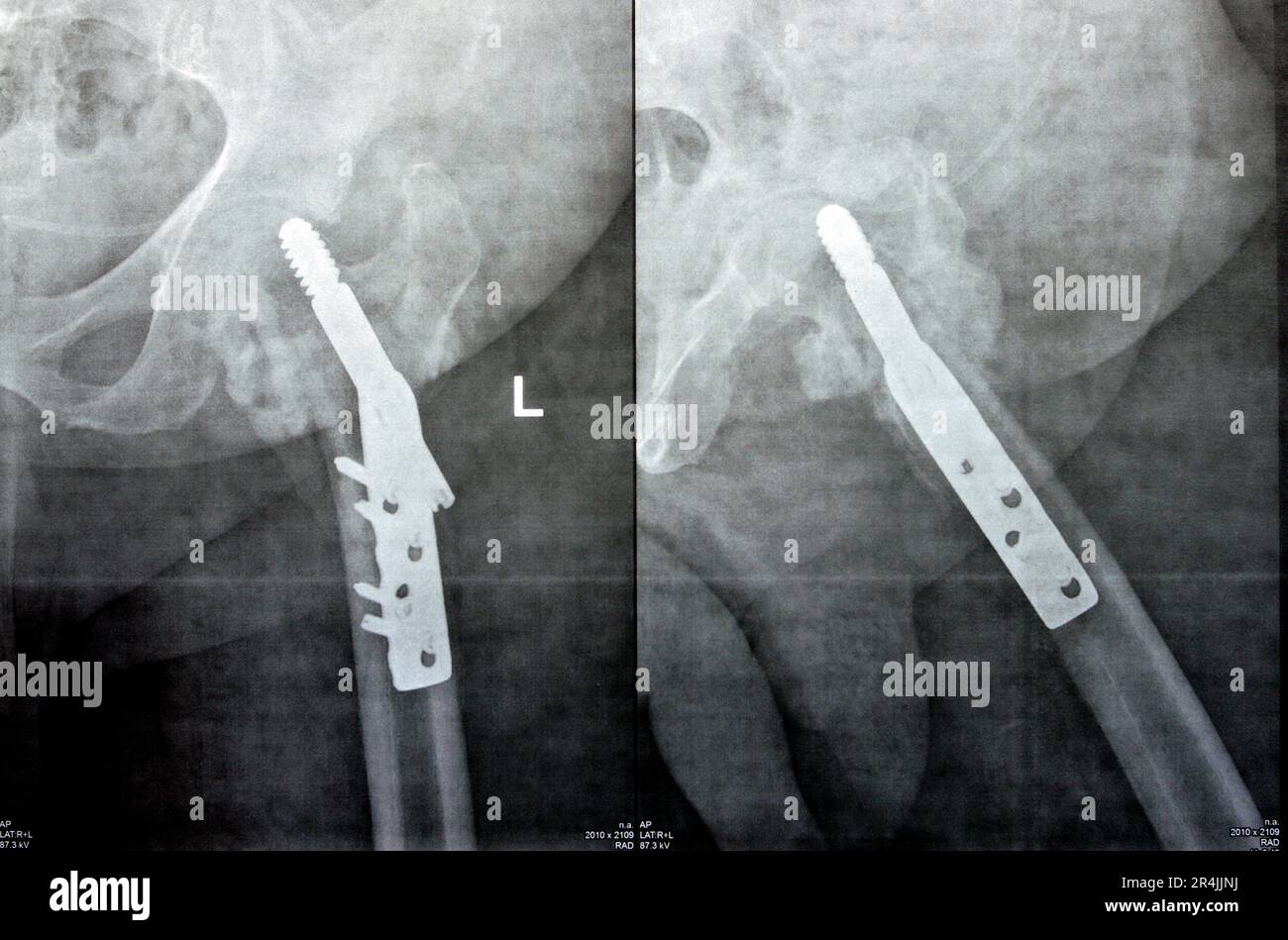Left hip trans cervical neck of femur fracture fixated by DHS Dynamic ...