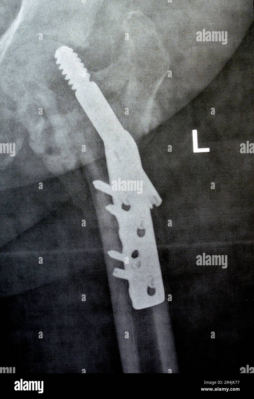 Left hip trans cervical neck of femur fracture fixated by DHS Dynamic ...