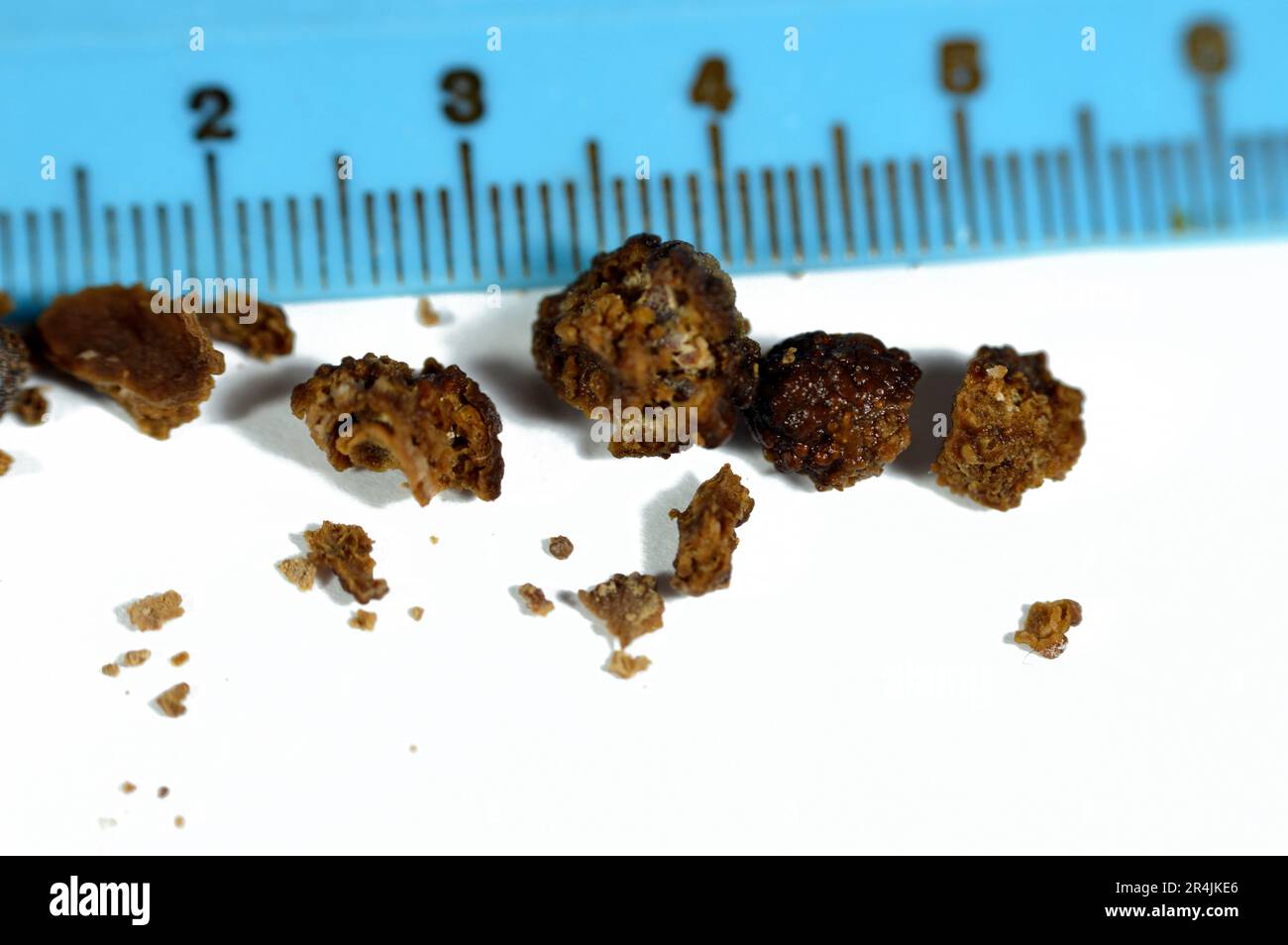 Nephrolithiasis, irregular brown kidney stones (renal calculus or ...