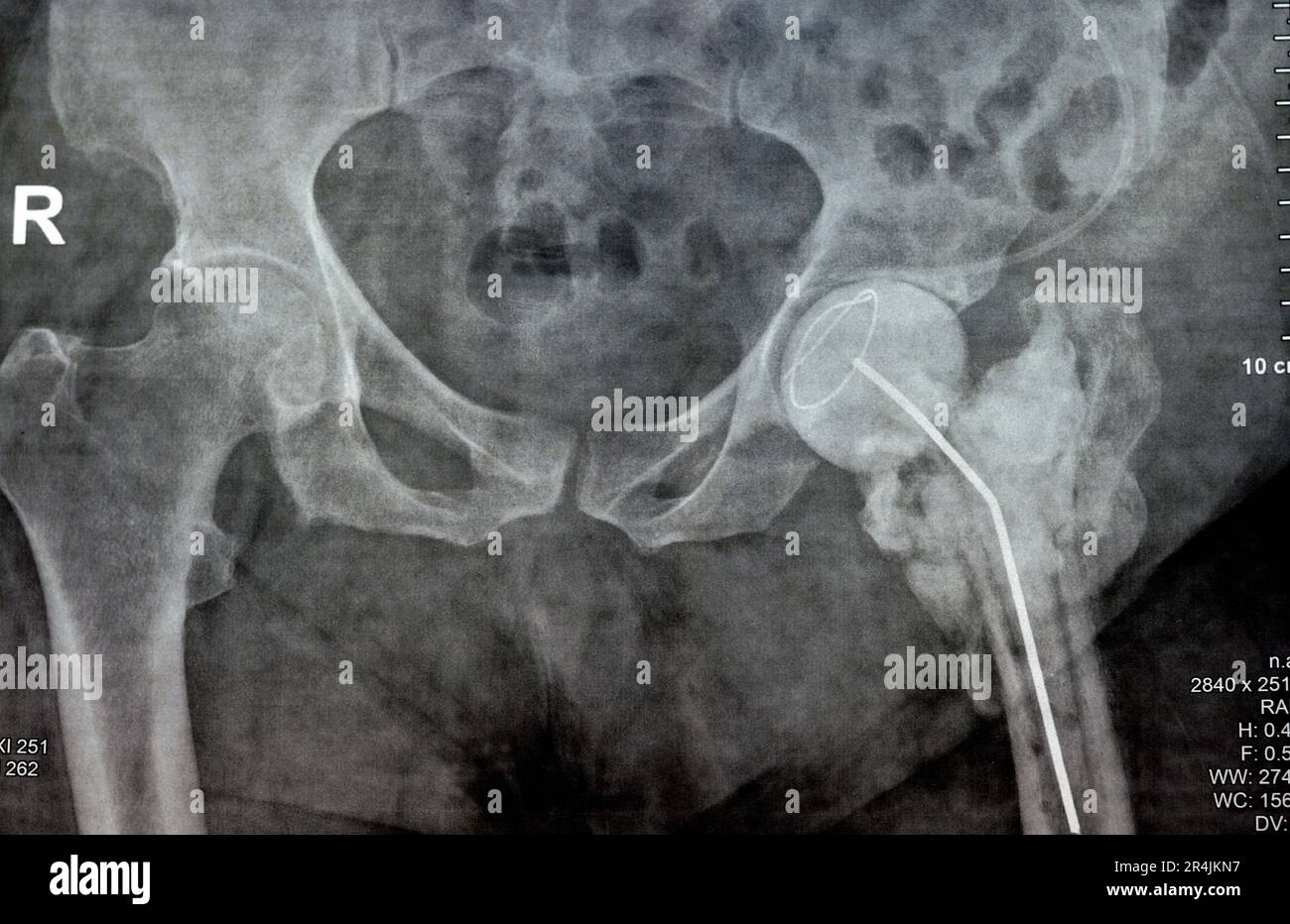 Plain X ray hip joint show left trans cervical fracture of the head of ...