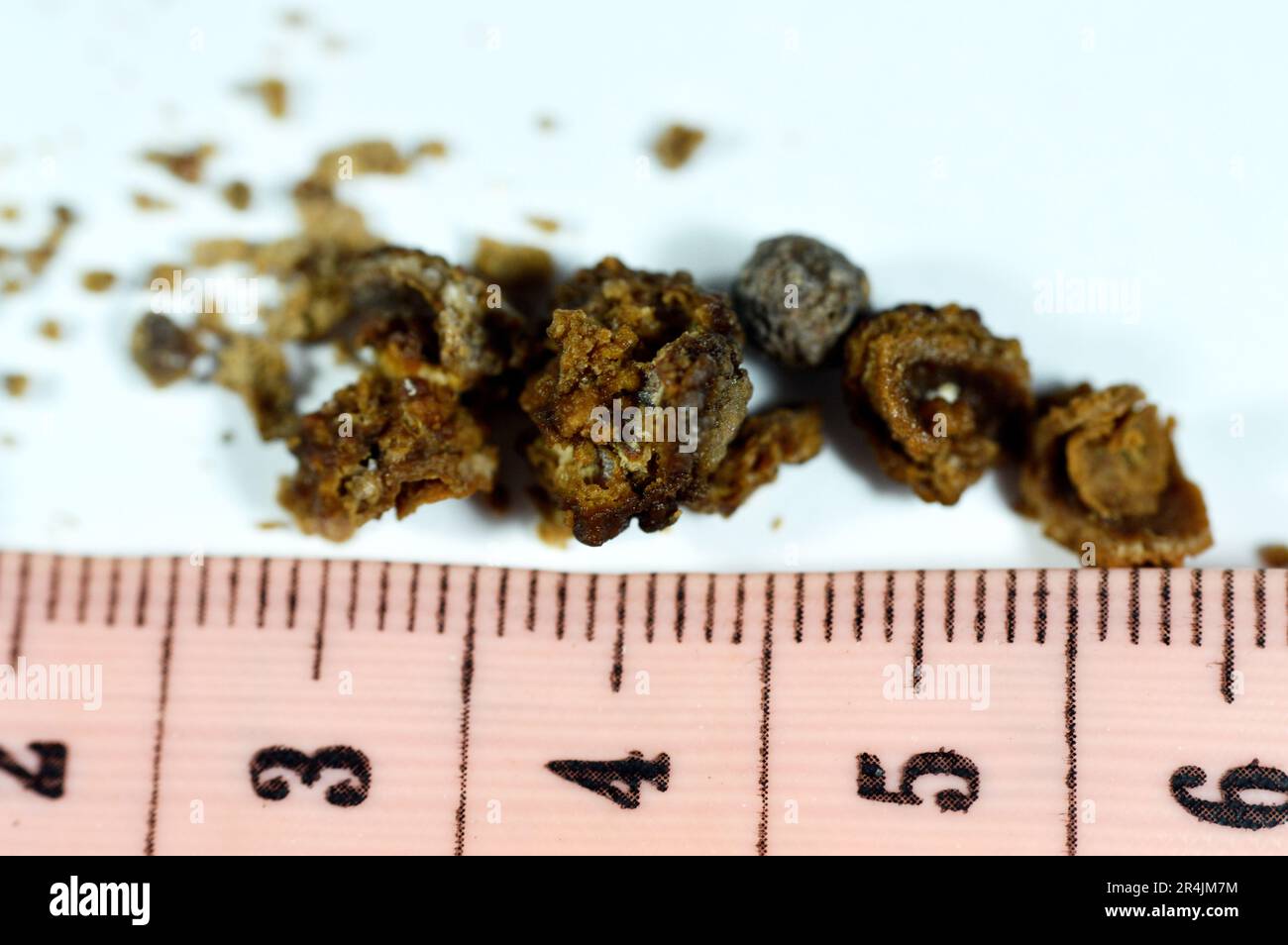 Nephrolithiasis, irregular brown kidney stones (renal calculus or ...