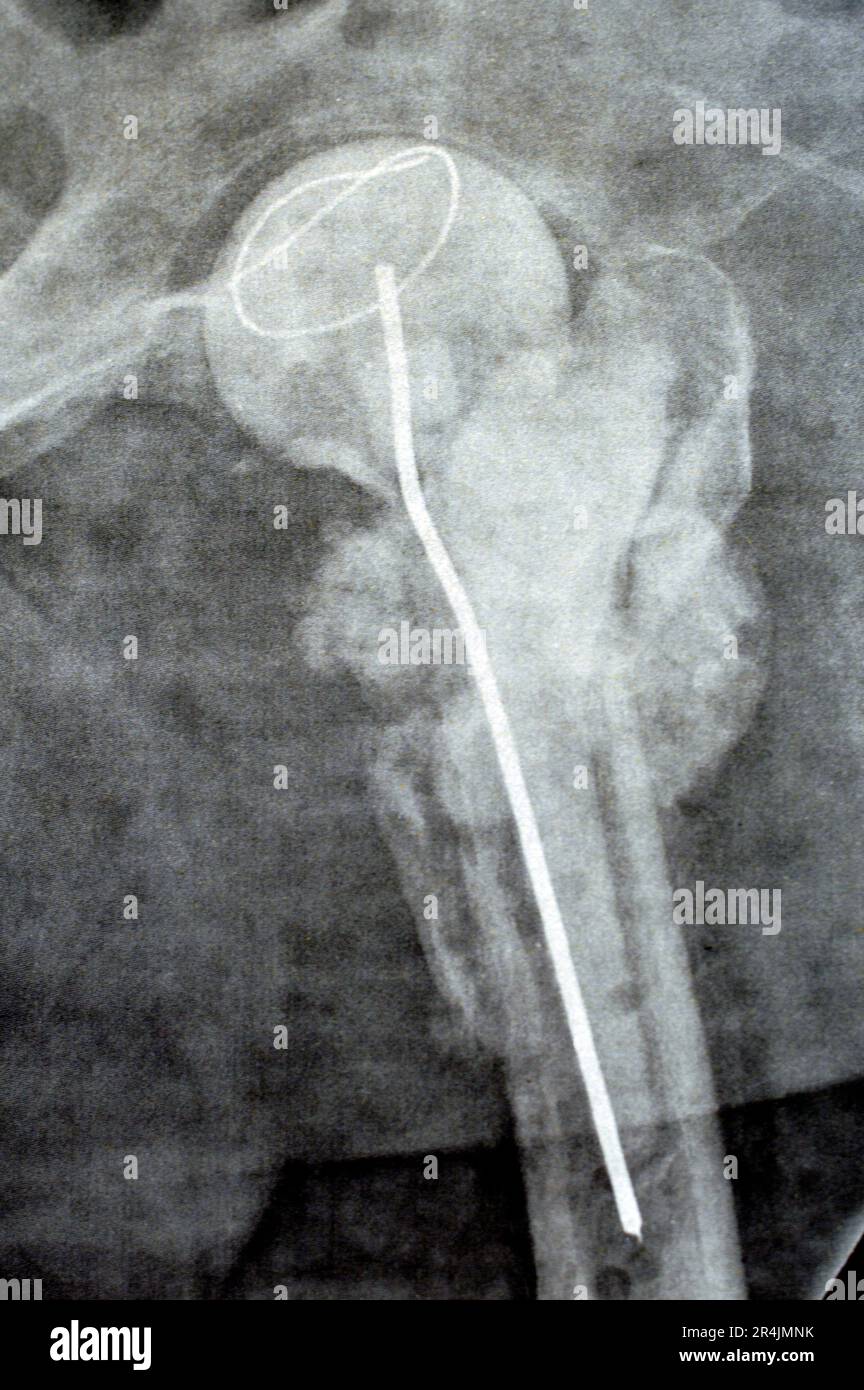 Plain X ray hip joint show left trans cervical fracture of the head of ...