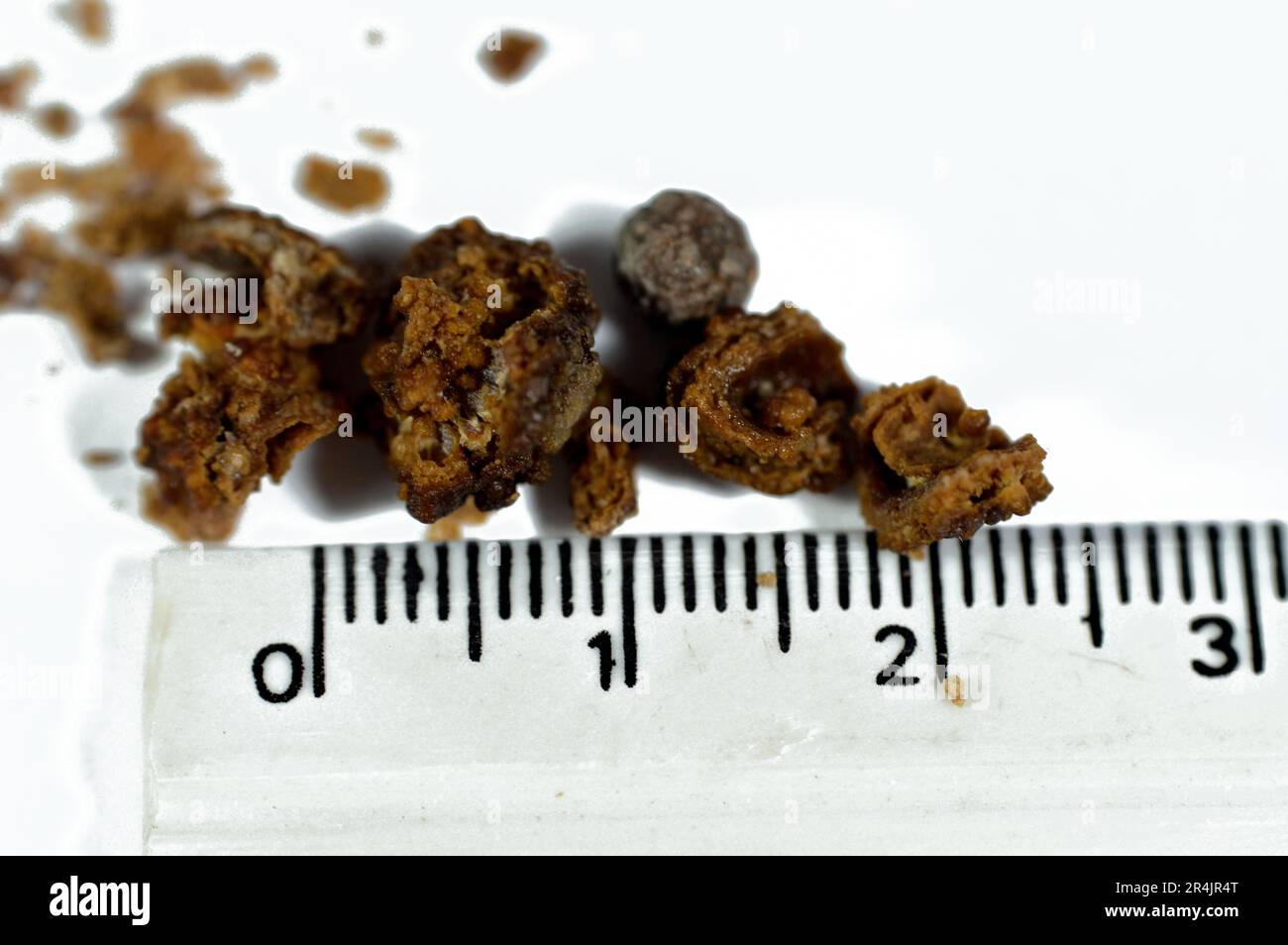 Kidney stones hi-res stock photography and images - Alamy
