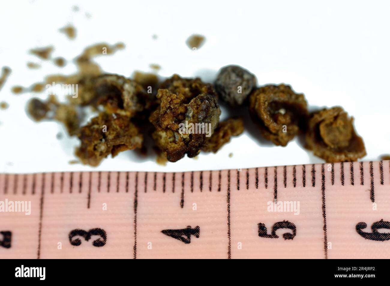 Nephrolithiasis, irregular brown kidney stones (renal calculus or ...