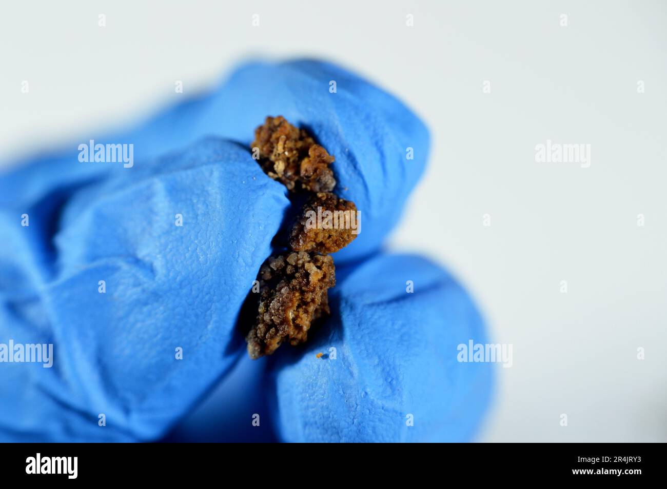 Nephrolithiasis, irregular brown kidney stones (renal calculus or ...