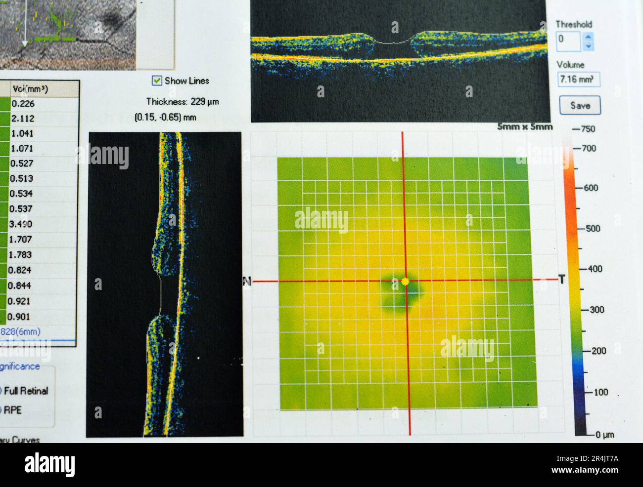 Epimacular hi-res stock photography and images - Alamy