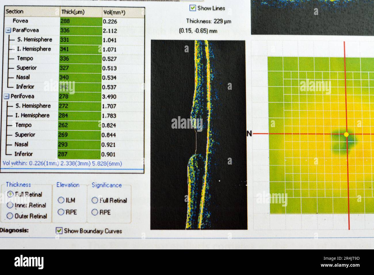 OCT of the eye reveals faint epimacular membrane and full thickness ...