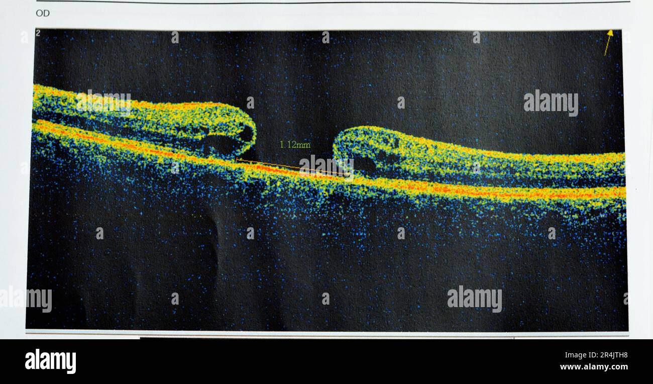 OCT of the eye reveals faint epimacular membrane and full thickness ...