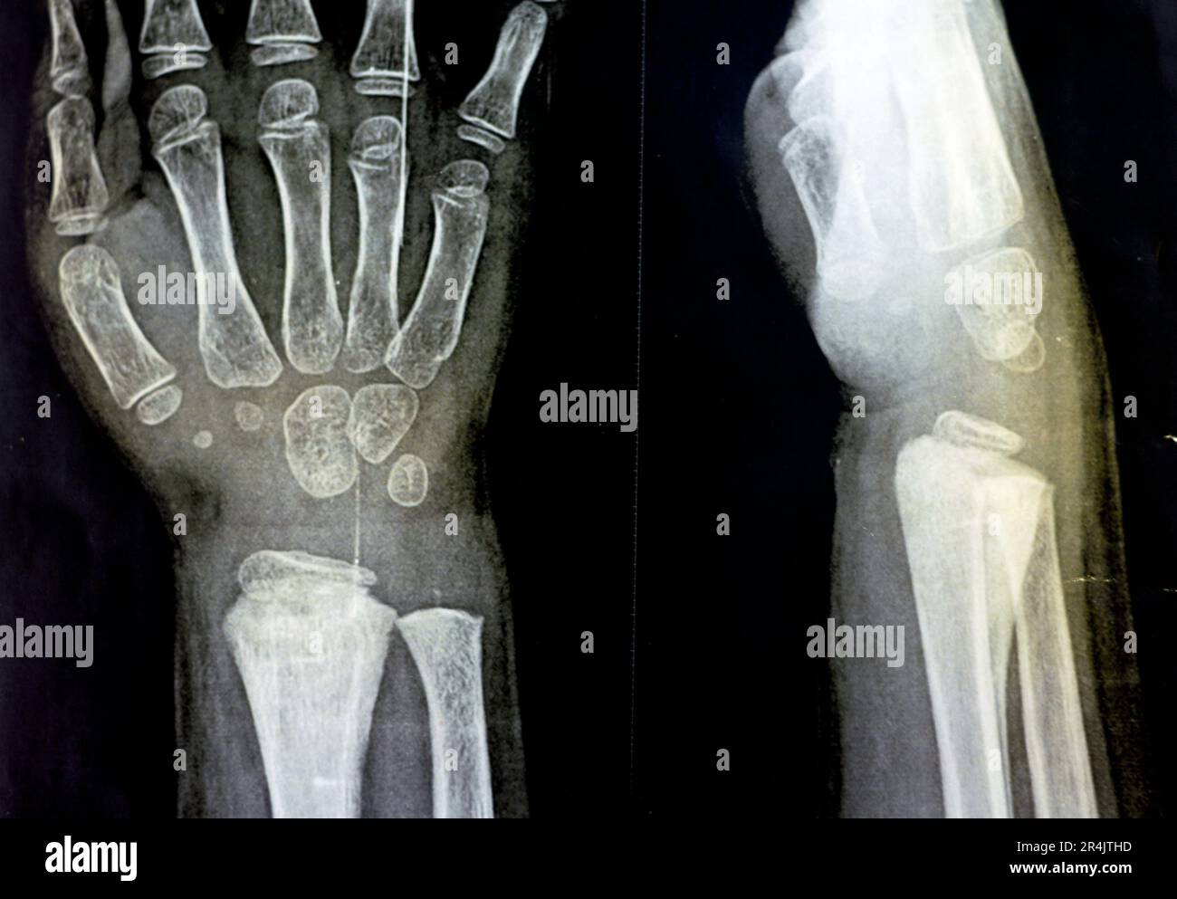 A PXR plain x ray of right wrist joint of skeletally immature female ...