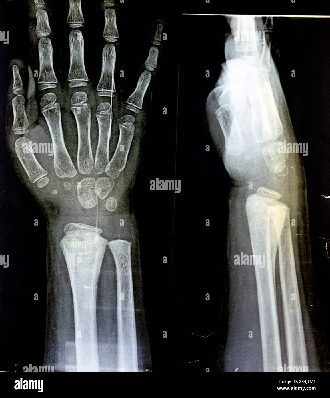 A PXR plain x ray of right wrist joint of skeletally immature female ...
