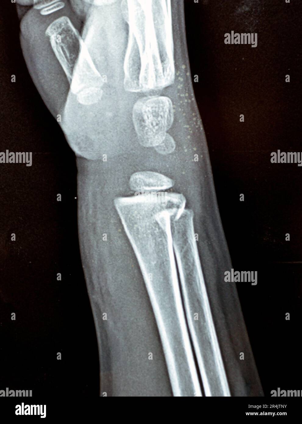 A PXR plain x ray of right wrist joint of skeletally immature female ...
