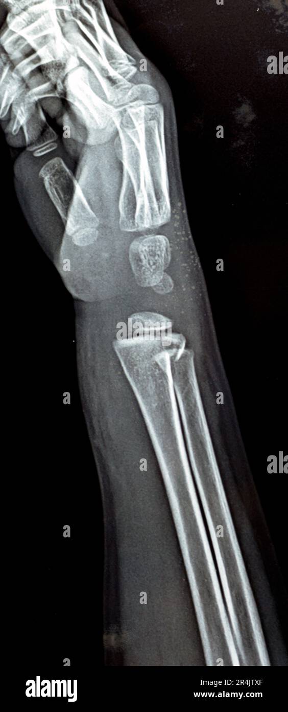 A PXR plain x ray of right wrist joint of skeletally immature female ...