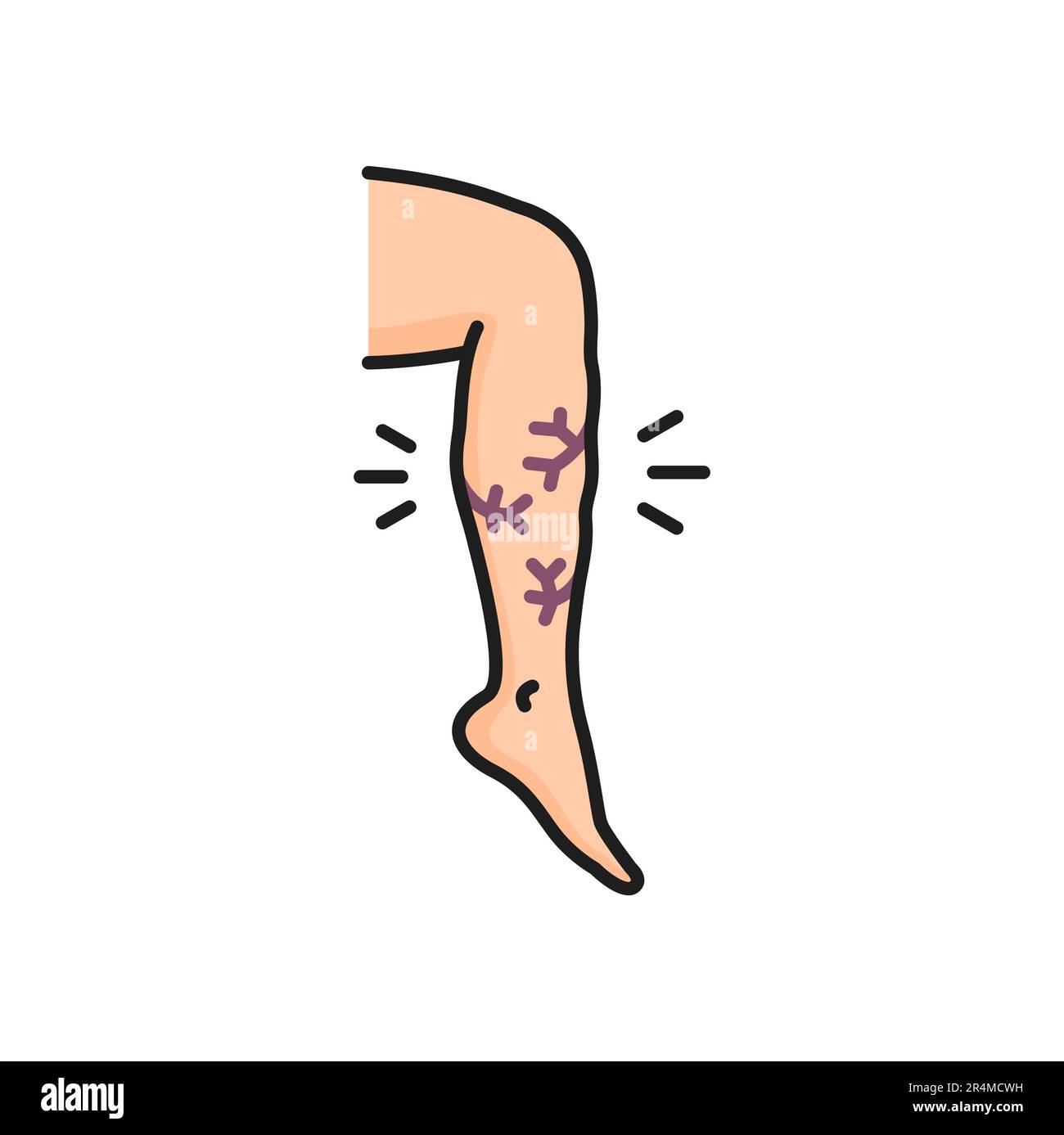 Venous mesh hi-res stock photography and images - Alamy