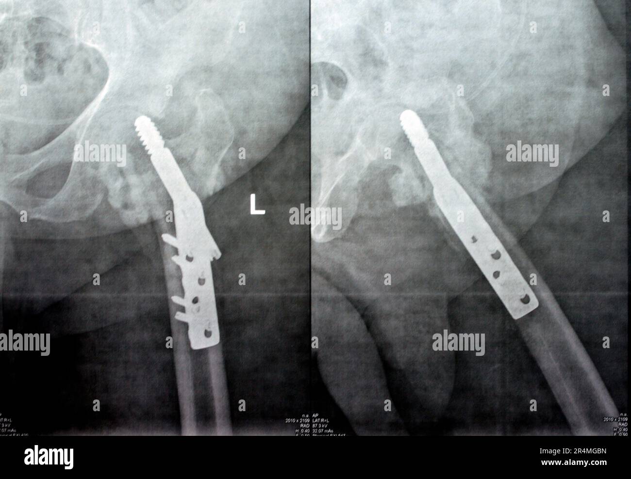 Left hip trans cervical neck of femur fracture fixated by DHS Dynamic ...