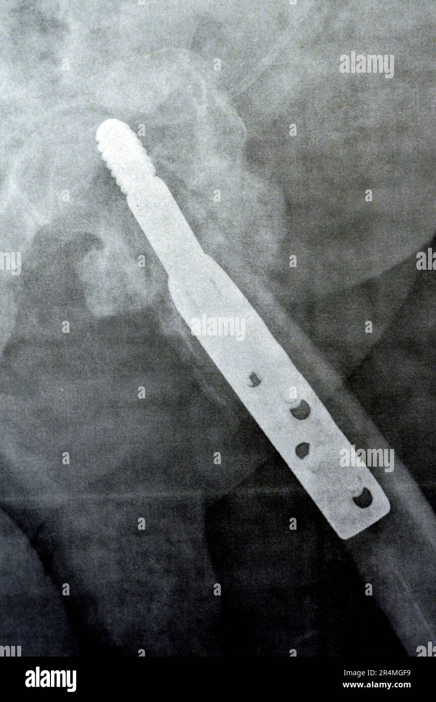 Left hip trans cervical neck of femur fracture fixated by DHS Dynamic ...