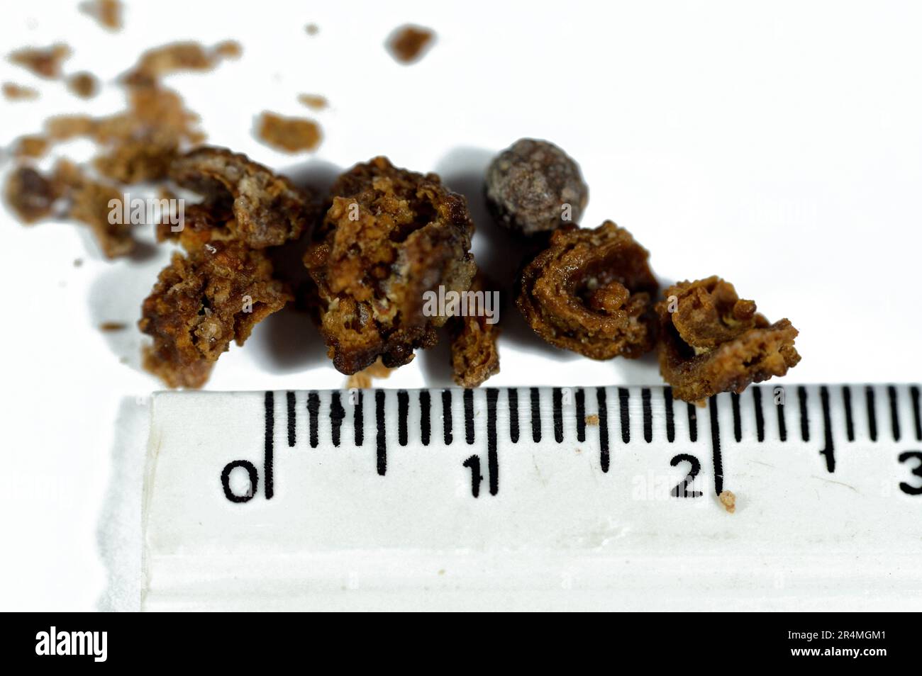 Calculus Kidney Stone