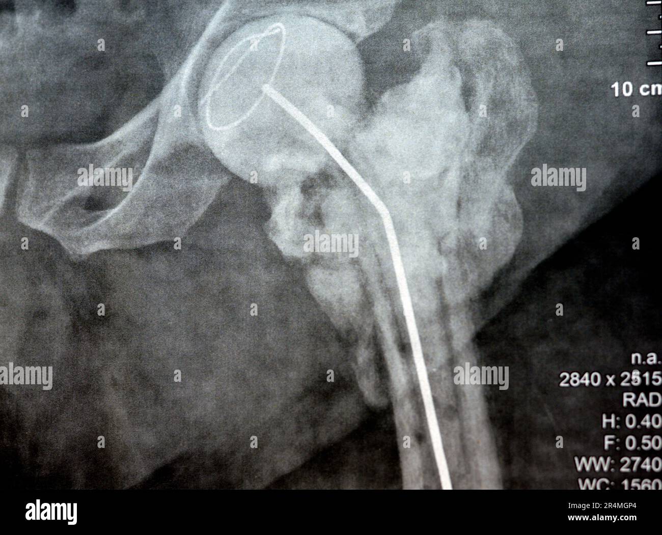 Plain X ray hip joint show left trans cervical fracture of the head of ...