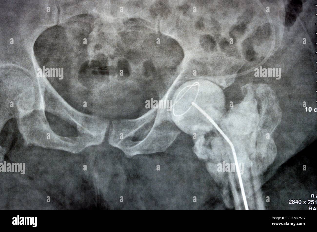 Plain X ray hip joint show left trans cervical fracture of the head of ...